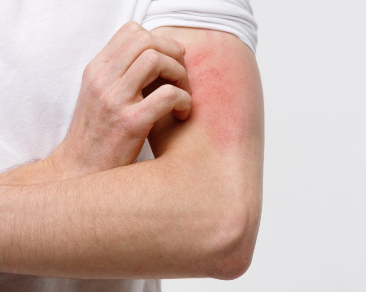 Scabies erkennen und behandeln: Die Hauterkrankung Krätze